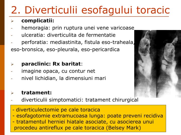 PPT - PATOLOGIA ESOFAGULUI (I) PowerPoint Presentation - ID:1441929
