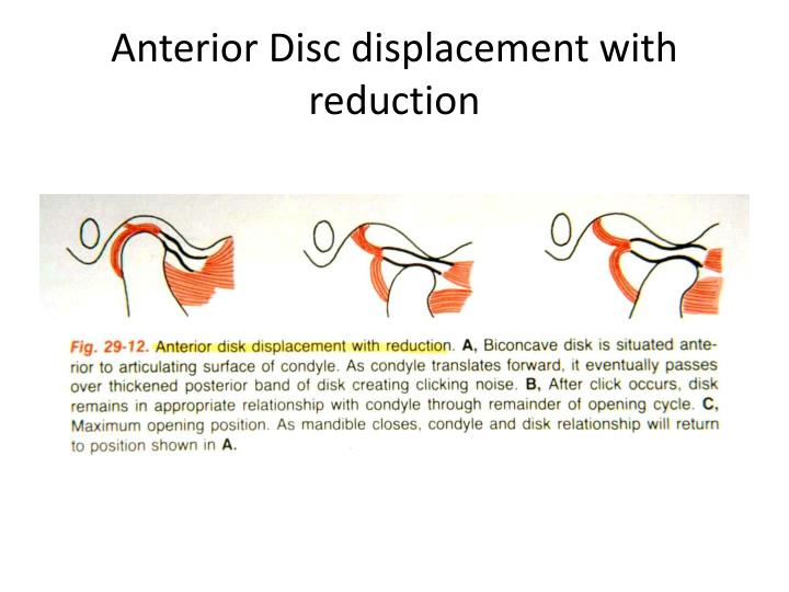 PPT - Management of TMJ disorders PowerPoint Presentation - ID:1444815