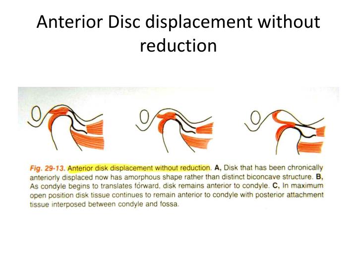 PPT - Management of TMJ disorders PowerPoint Presentation - ID:1444815
