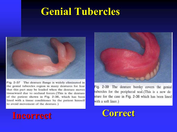 PPT - Anatomy of Mandibular Denture Bearing Area PowerPoint ...
