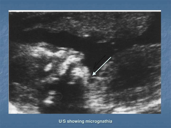 PPT - CONGENITAL ANOMALIES (Birth defects) PowerPoint Presentation - ID ...