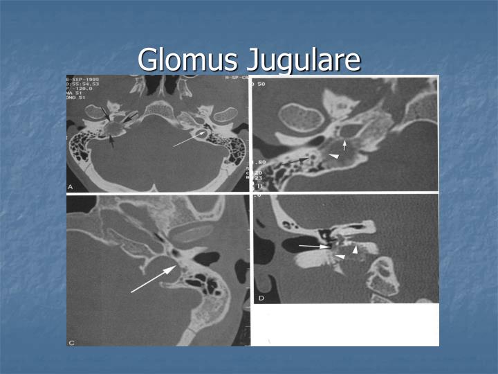 PPT - Cerebellopontine Angle Masses PowerPoint Presentation - ID:1448740