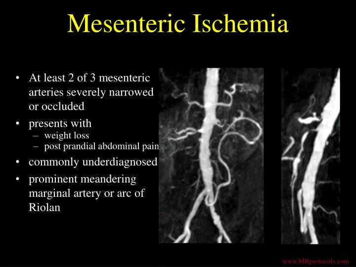 PPT - Mesenteric Ischemia PowerPoint Presentation, free download - ID ...