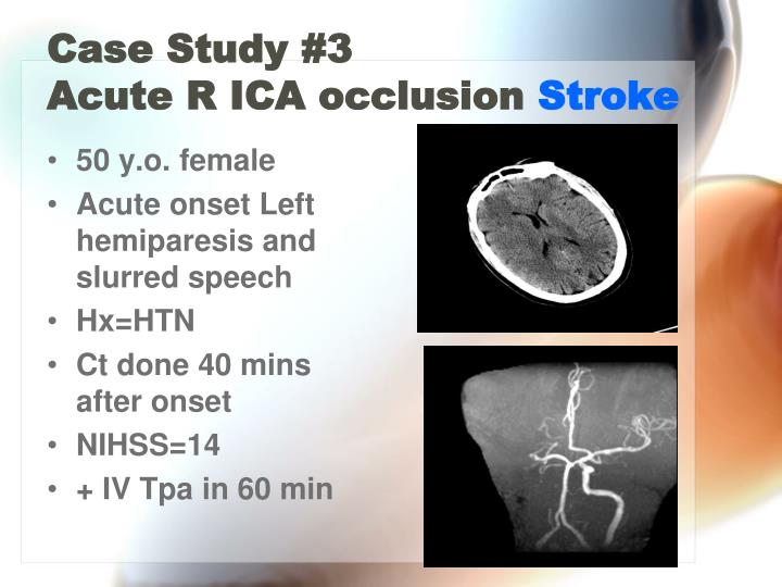 PPT - Intraarterial thrombolytic treatment PowerPoint Presentation - ID ...
