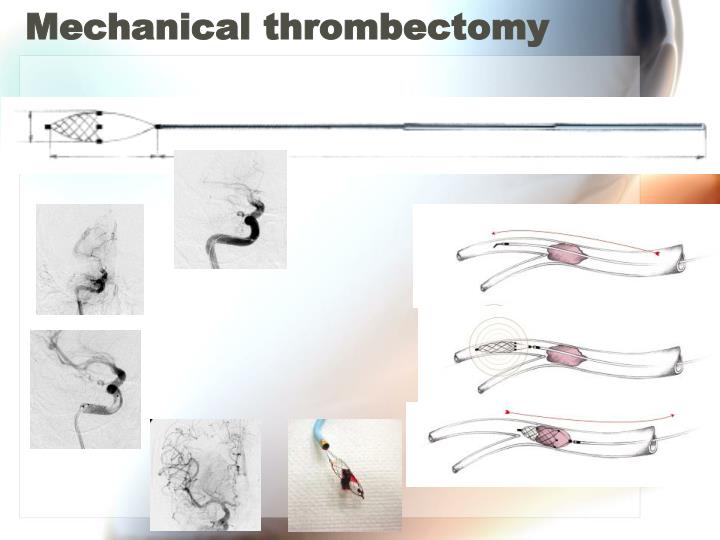 PPT - Intraarterial thrombolytic treatment PowerPoint Presentation - ID ...