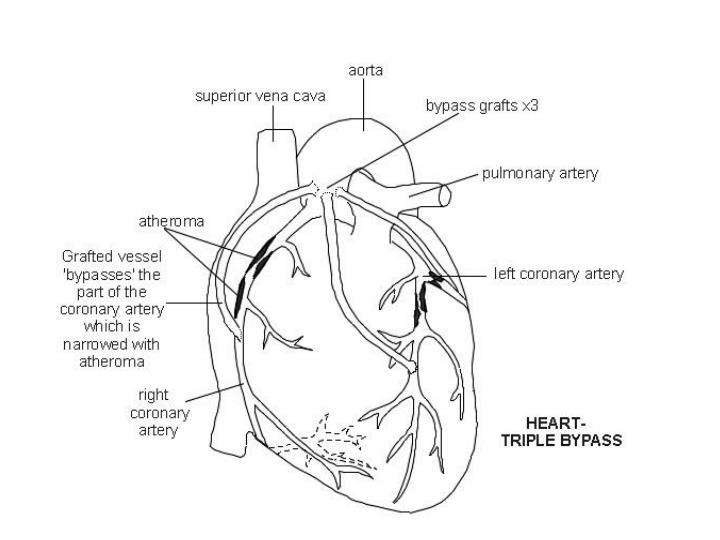 PPT - Cardiopulmonary Bypass PowerPoint Presentation - ID:1454824