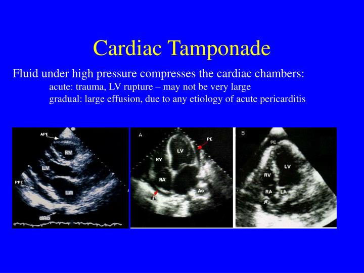 PPT - Pathophysiology of Pericardial Disease IMS 350 PowerPoint ...