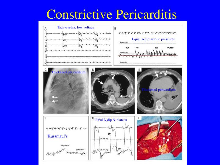 PPT - Pathophysiology of Pericardial Disease IMS 350 PowerPoint Presentation - ID:146188