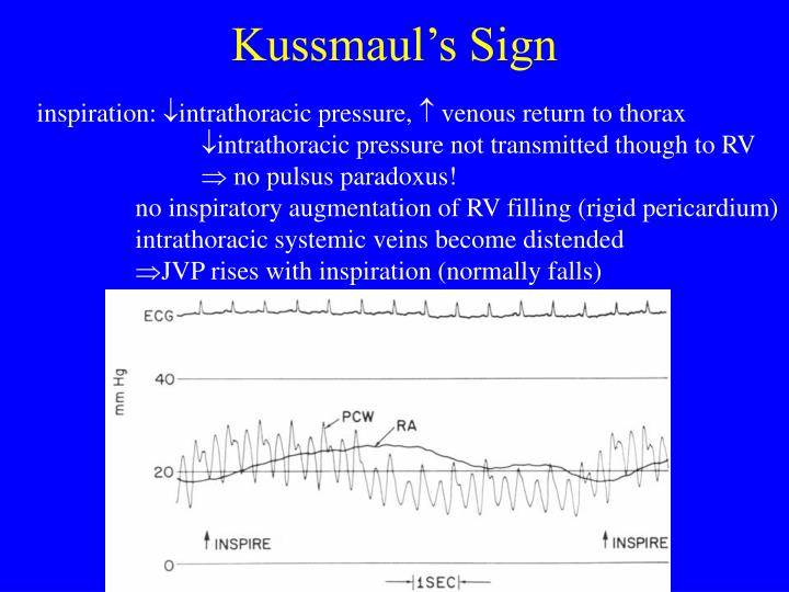 PPT - Pathophysiology of Pericardial Disease IMS 350 PowerPoint ...