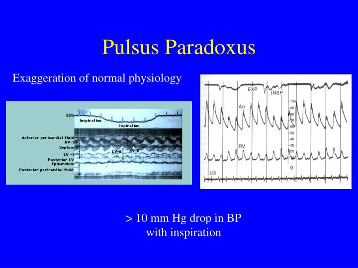 PPT - Pathophysiology of Pericardial Disease IMS 350 PowerPoint ...