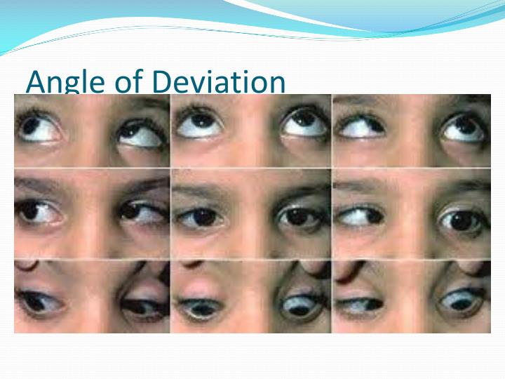 PPT - Strabismus for 5 th yr medical students PowerPoint Presentation ...