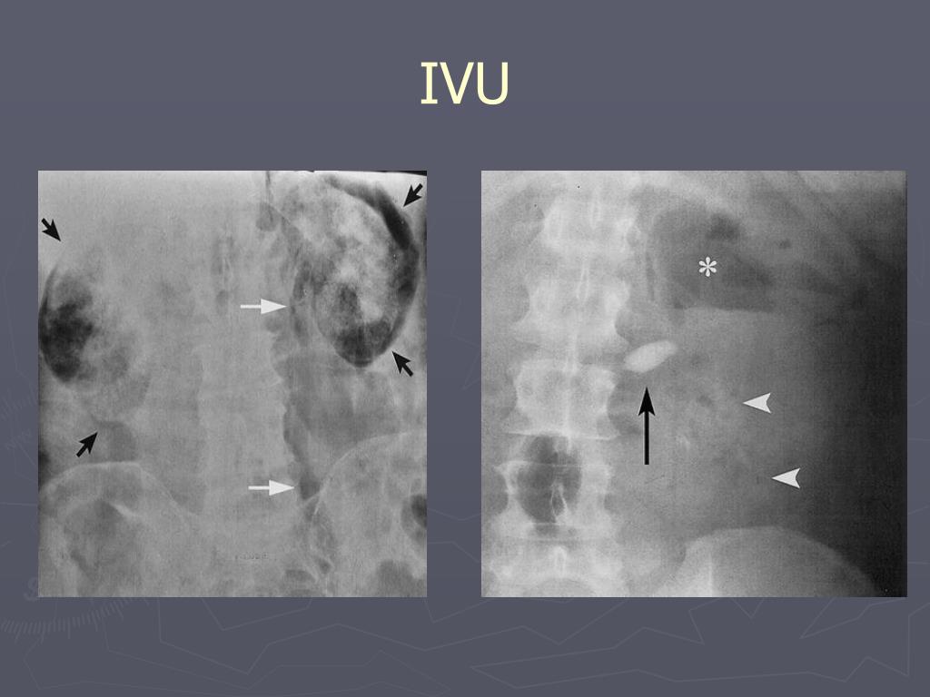 PPT - N eerude p õletikulised haigused PowerPoint Presentation, free ...
