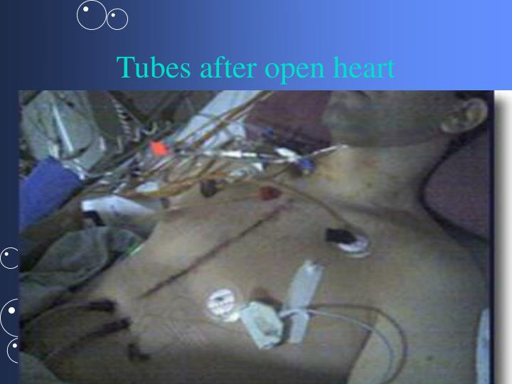 PPT - OPEN HEART SURGERY PowerPoint Presentation - ID:1464751