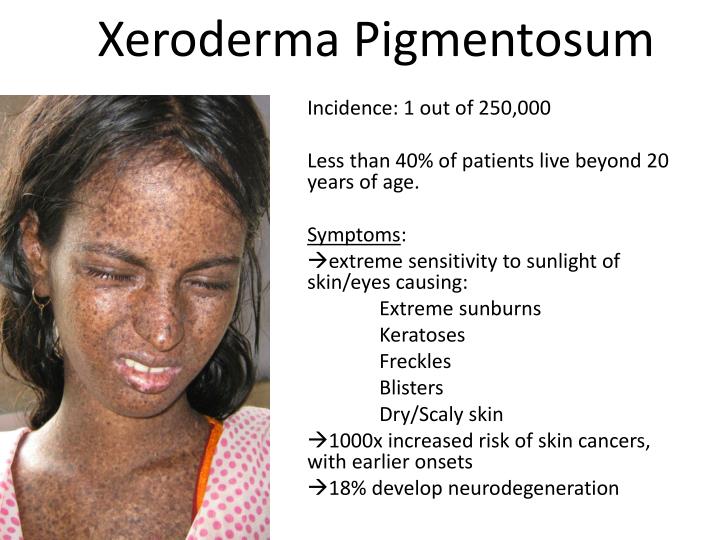 Xeroderma Pigmentosum Chromosomes Xeroderma Pigmentosum = جفاف