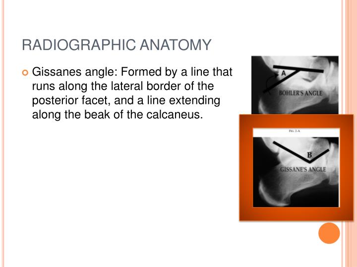 PPT - Calcaneal Fractures PowerPoint Presentation - ID:1474016