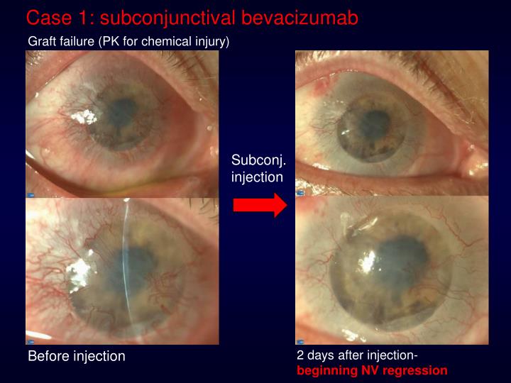 PPT - Topical and Subconjunctival Bevacizumab in Corneal ...