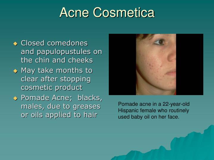 PPT - Acne PowerPoint Presentation - ID:148058