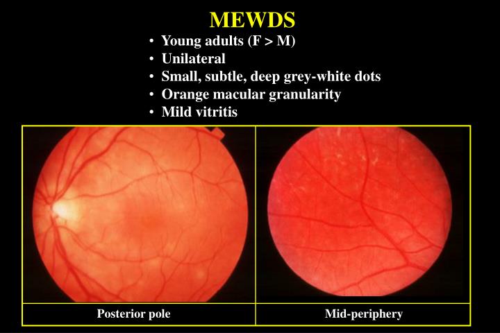 PPT - IDIOPATHIC INFLAMMATORY WHITE DOT SYNDROMES PowerPoint ...