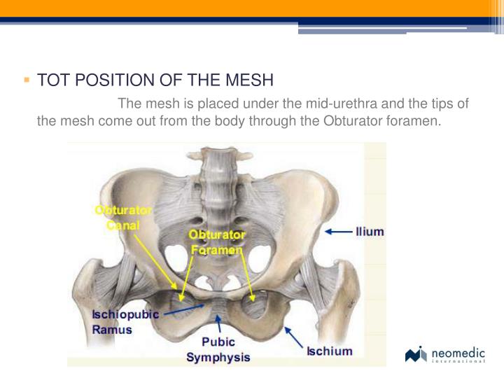 PPT - TVT PROCEDURE – TOT PROCEDURE PowerPoint Presentation - ID:1486713
