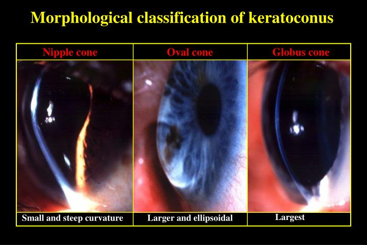 PPT - 1. Keratoconus PowerPoint Presentation - ID:1489622