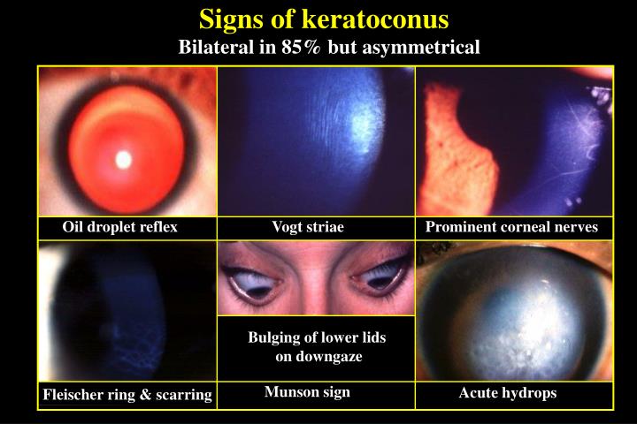 PPT - 1. Keratoconus PowerPoint Presentation - ID:1489622