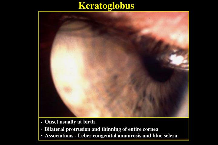 PPT - 1. Keratoconus PowerPoint Presentation - ID:1489622