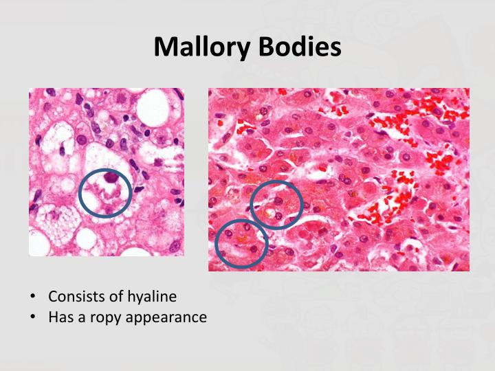PPT - Pathology Quiz - Liver PowerPoint Presentation - ID:1489808