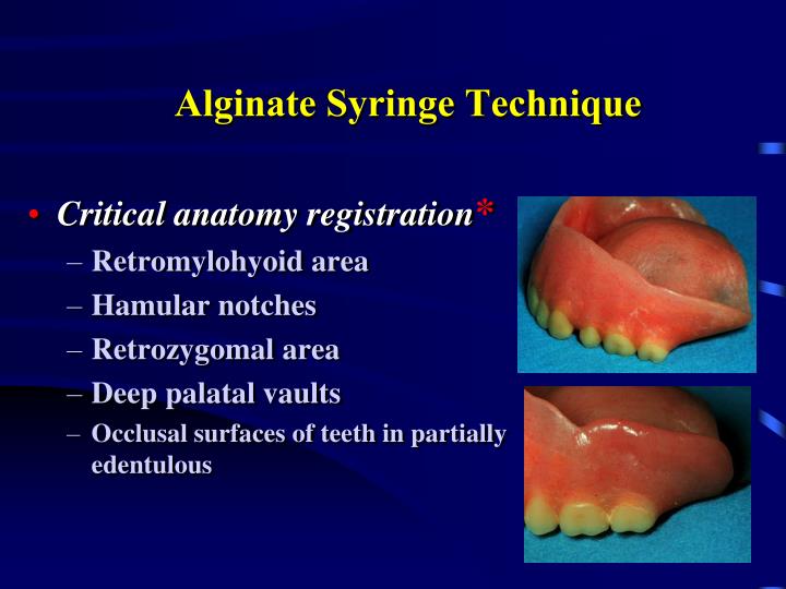PPT - Preliminary Edentulous Impressions & Custom Tray Fabrication ...