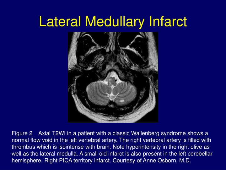 PPT - Lateropulsion PowerPoint Presentation - ID:1491394