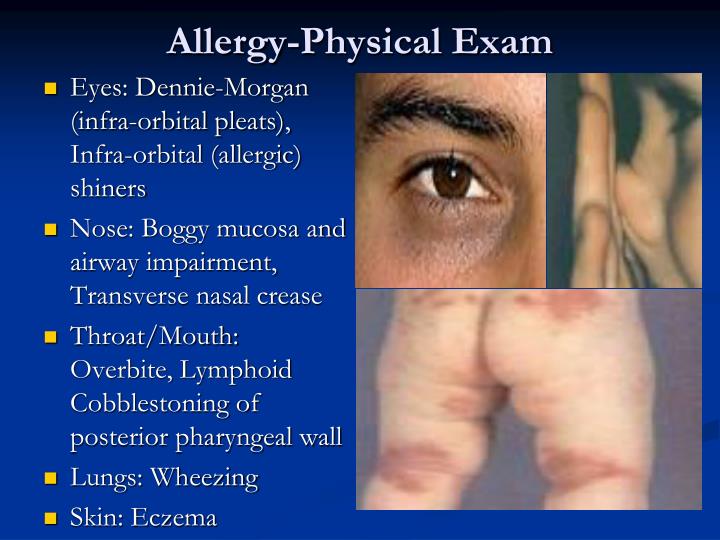 PPT - Allergy/ Immunology Board Review PowerPoint Presentation - ID:149332