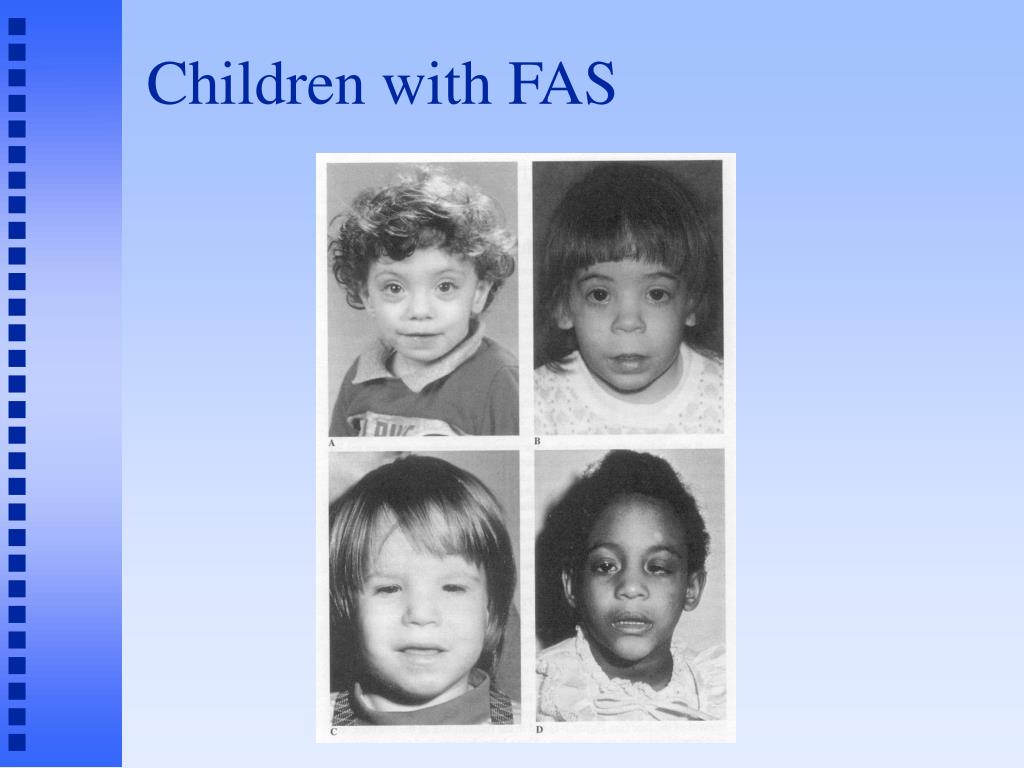 PPT - Fetal Alcohol Syndrome Fetal Alcohol Effects Alcohol-Related ...