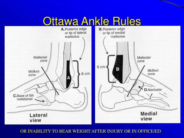 PPT - Everything You Ever Wanted to Know About Ankle Sprains PowerPoint ...