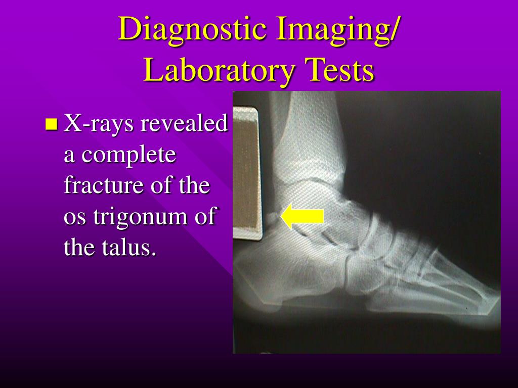 PPT - Acute Posterior Ankle Pain in a High School Football Player ...