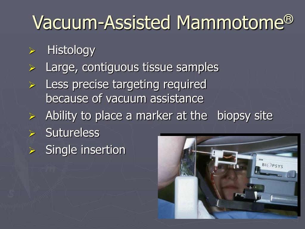 PPT - Minimally Invasive Breast Procedures PowerPoint Presentation - ID ...