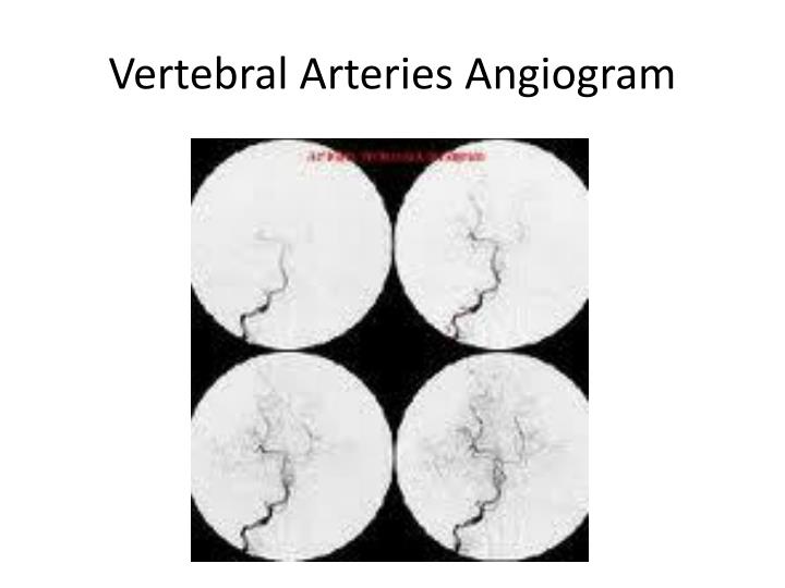 PPT - Cerebral Angiography PowerPoint Presentation - ID:154664