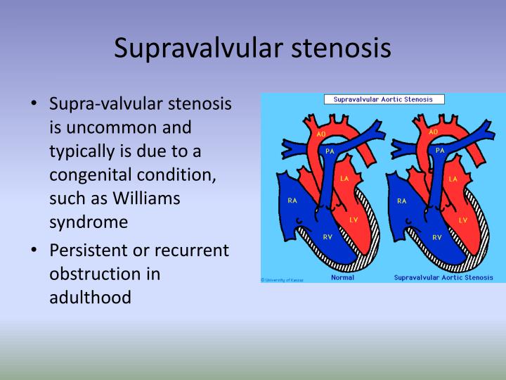 PPT - Aortic Stenosis PowerPoint Presentation - ID:157153