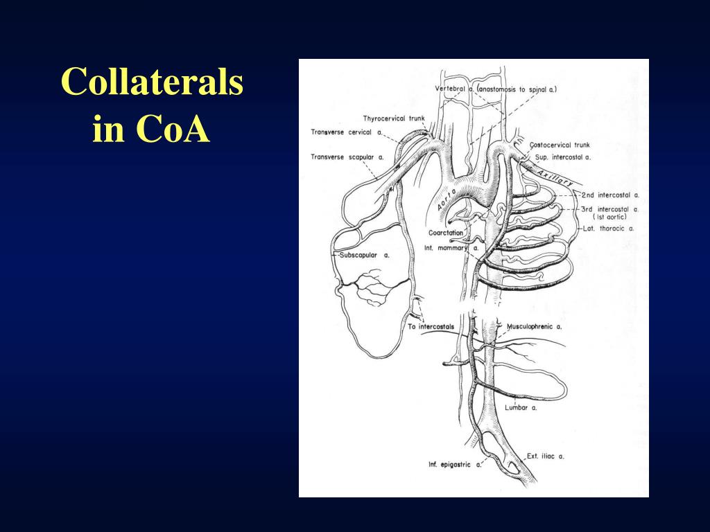 Ppt Coarctation Of Aorta Powerpoint Presentation Free Download Id157220
