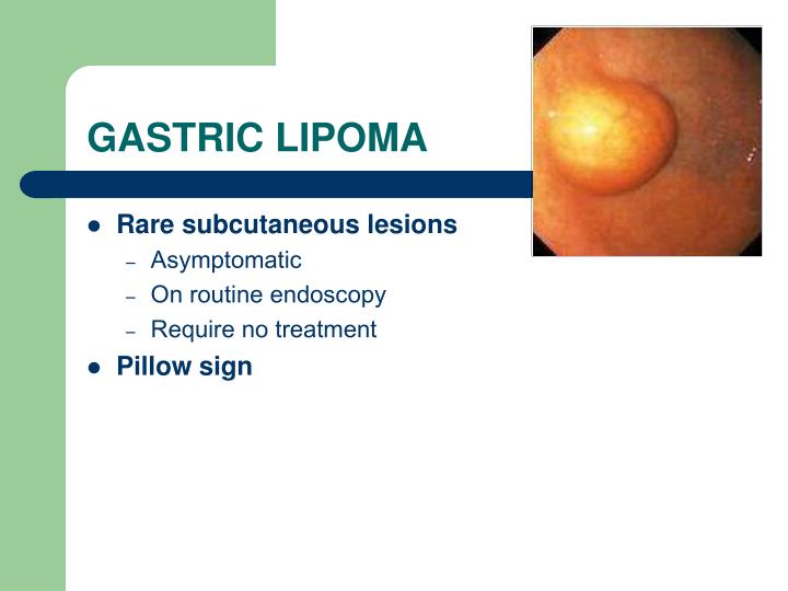 PPT - Tumors of the stomach and duodenum PowerPoint Presentation - ID ...