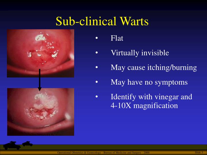 PPT - Human Papilloma Virus HPV PowerPoint Presentation - ID:158837