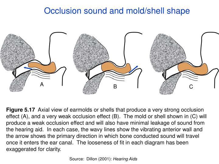 PPT - Figures for Chapter 5 Earmolds and earshells PowerPoint ...