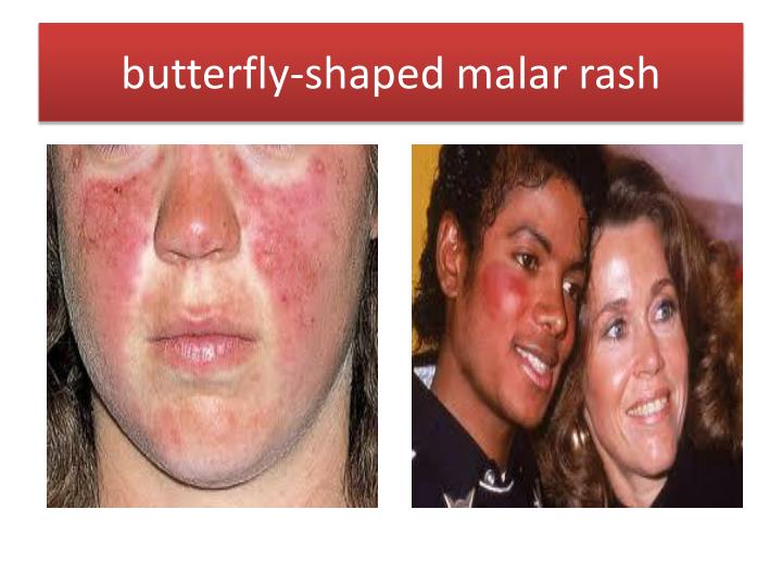 PPT - SYSTEMIC LUPUS ERYTHEMATOSUS BY DR BASHIR AHMED DAR PowerPoint ...