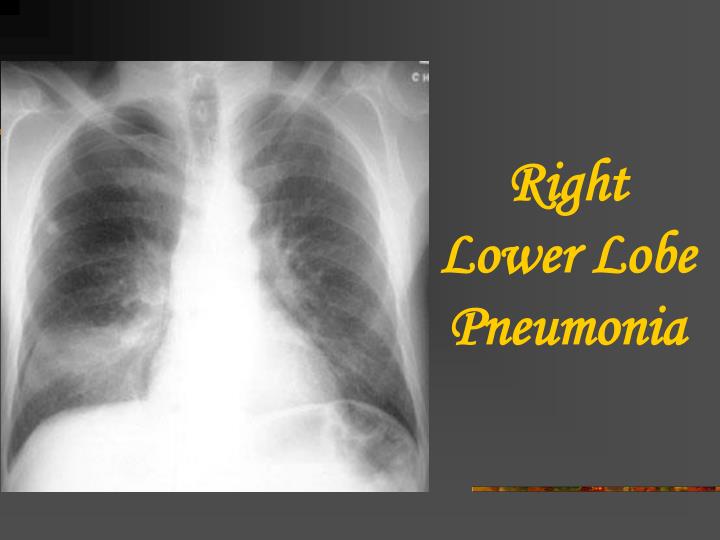 PPT - Chest X-Ray Review PowerPoint Presentation - ID:172434