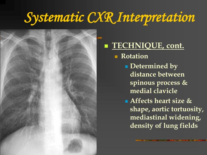PPT - Chest X-Ray Review PowerPoint Presentation - ID:172434