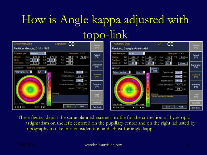 PPT - Comparison of topography-guided (TGL) to standard LASIK (SL) for ...