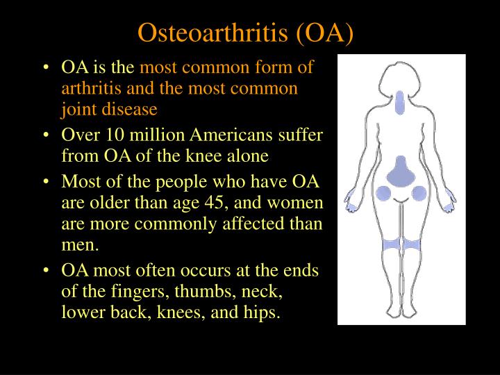 PPT - Osteoarthritis PowerPoint Presentation - ID:176417