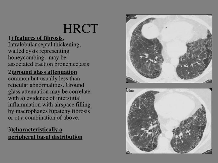 PPT - Radiology of Connective Tissue Disease associated Interstitial ...