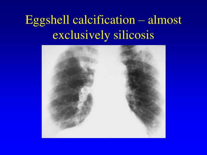 PPT - Silicosis: Medical Aspects PowerPoint Presentation - ID:178112