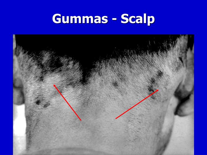 PPT - Syphilis – Clinical Aspects of Late Syphilis PowerPoint ...