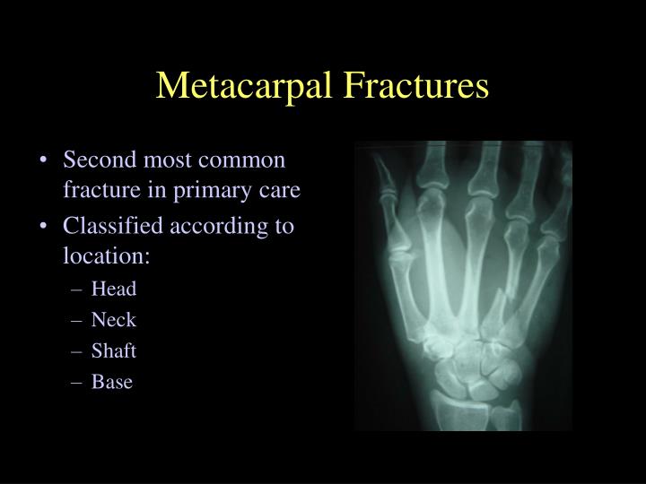 PPT - Management of Extremity Fractures PowerPoint Presentation - ID:182329