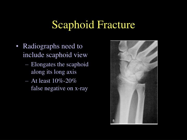 PPT - Management of Extremity Fractures PowerPoint Presentation - ID:182329